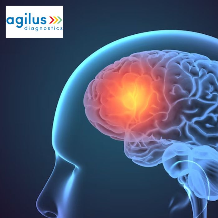 Brain Disorders: Types, Causes, Symptoms, Treatment - Agilus Diagnostics