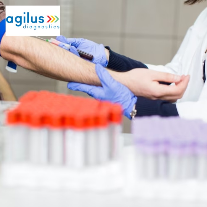 What Do You Need To Know About The CBC Blood Test? - Agilus Diagnostics