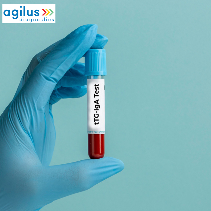 Understanding The Tissue Transglutaminase IgA Test - Agilus Diagnostics